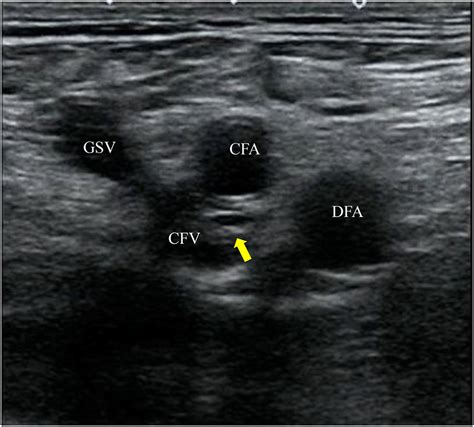 Superficial Femoral Vein Ultrasound