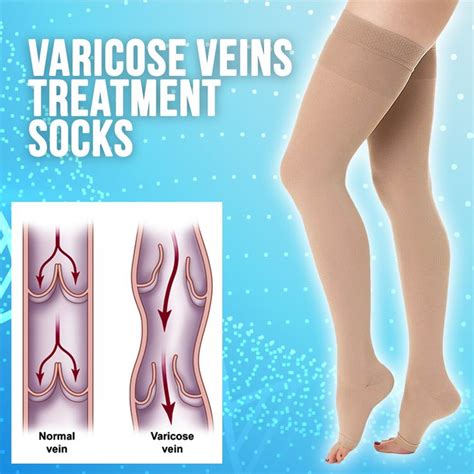 Heal Your Varicose Veins With Mix Varicose Veins Varicose Veins