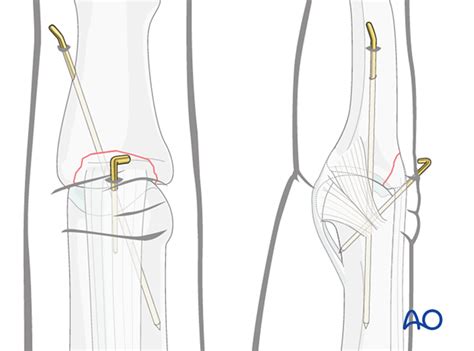 Extensor Block Pinning With Joint Transfixation For Dorsal Avulsion Of