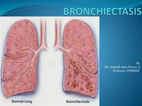 Bronchiectasis Pptx