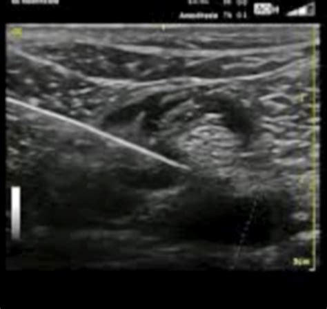 Hydrodissection Does Not Have To Be A Pain Ultrasound Guided Treatment