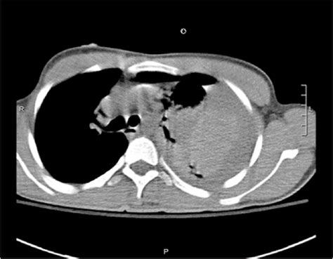 Ct Image Of Hemopneumothorax Download Scientific Diagram