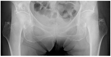 Non Displaced Cervical Fracture