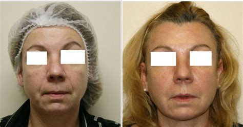 Lifting Sans Chirurgie 02 Docteur Azoulay