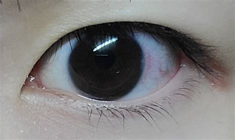 눈 한쪽만 충혈 동공 근처 지식in