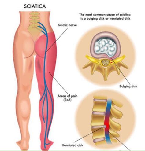 Return To Peace Healing Techniques Specialising In Bowen Technique