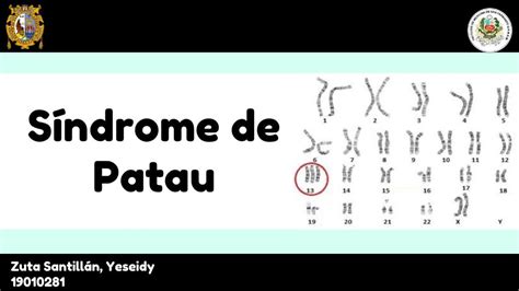 Síndrome De Patau Síndrome Cromosoma Udocz