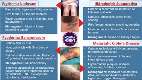 Erythema Nodosum African American