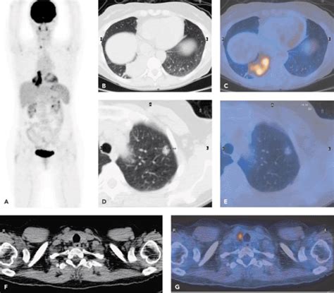 PET And PET CT Of Non Small Cell Lung Cancer Radiology Key