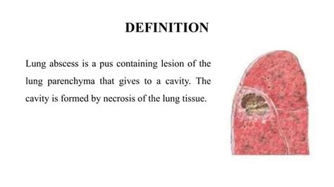 Lung Abscess And Nursing Care Pptx