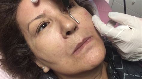 Resurfacing Plasmage Youtube