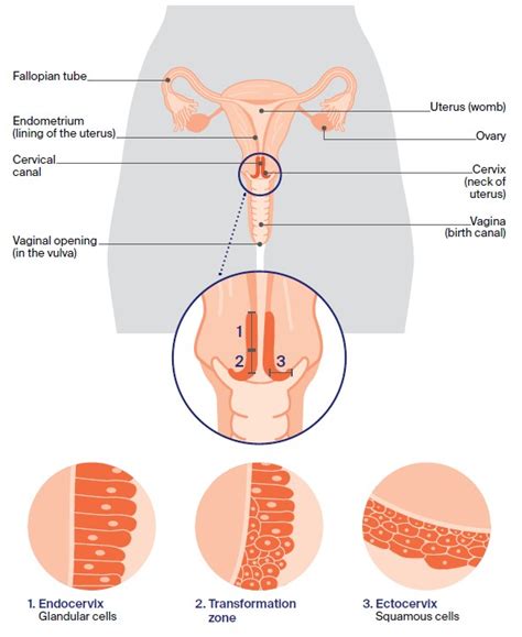 Cervical Cancer Check Symptoms Types What Causes It And Risk Factors
