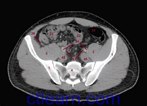 Ct Anatomy Pelvis Scan Muscle Pelvic Axial Iliacus Bo