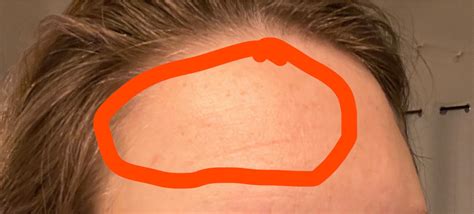 Just Turned 30 And Have These Forehead Lines For About A Year Is There