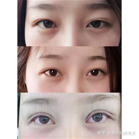 这双眼皮做得好好看妈生感超强善美宁双眼皮 知乎