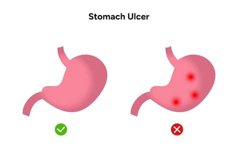 Premium Vector Stomach Ulcer Symptoms Peptic Ulcer