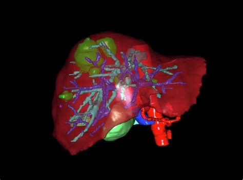 3d Reconstruction Patient Specific 3d Model Of The Liver Generated By Download Scientific