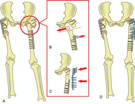 Open Reduction Internal Fixation Hip
