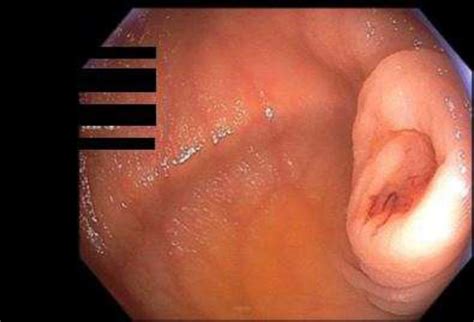 Appendiceal Orifice With Residual Blood On Colonoscopy Download