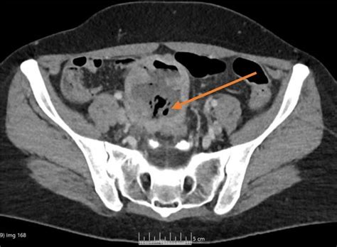 CT Axial Image With Arrow Showing The Midline Lower Abdominal Pelvic