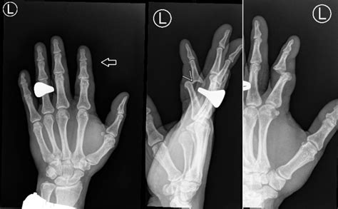 Proximal Interphalangeal Joint Dislocation Handipedia