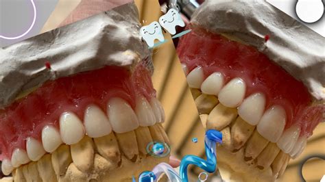 Wax Carving Of Denture Make Denture Looks Good Dental Umair