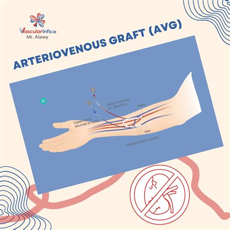 Vascular Access For Haemodialysis Vascular Info