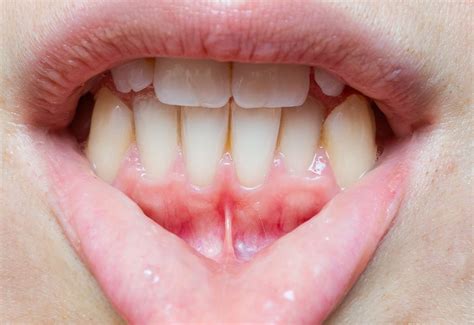 Frenectomy Worthington Periodontal Specialists Worthington Oh
