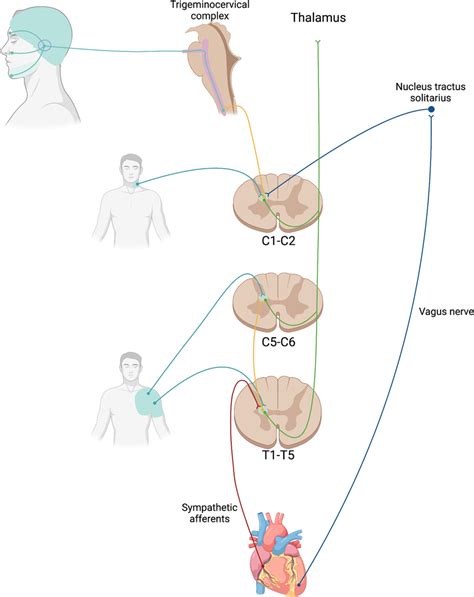 Convergence Theory Of Cardiac Cephalalgia Adapted From Foreman [58] Download Scientific