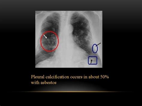 Pleural Disease Dr Nadya Ben Geweref Pleura Is