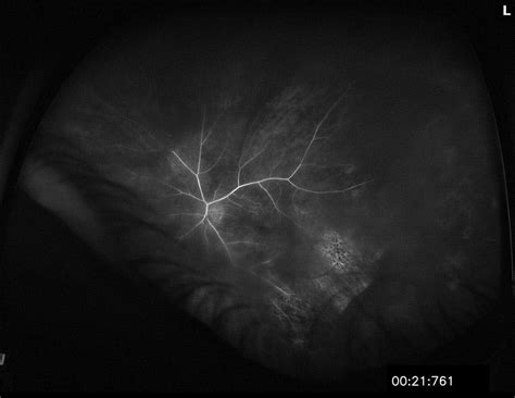 A Case Of Pehcr Retina Today