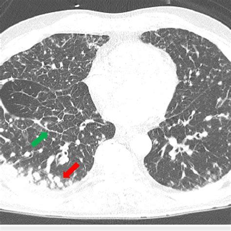 Contrast Enhanced Computed Tomography Scan Of The Chest Showing