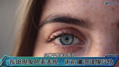影／夏季美白雷射網熱議 皮膚科醫：錯誤步驟讓皮膚受傷老化！