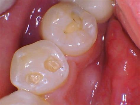 Instant And Accurate Detection Of Early Occlusal Caries Dentistry Today