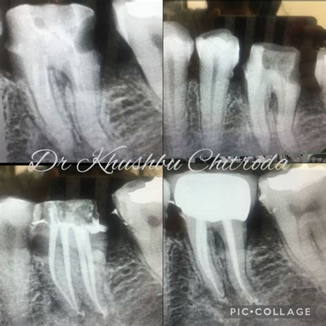 Dr Khushbu Ajmera Chitroda On Linkedin Endodontics