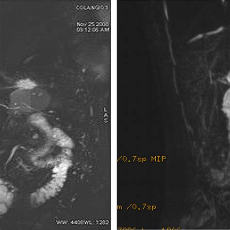 A Magnetic Resonance Cholangiopancreatography Mrcp Showing A Normal