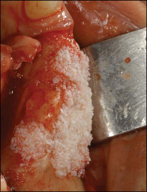 Osseous Defect Grafted With Biooss Occlusal View Download Scientific Diagram