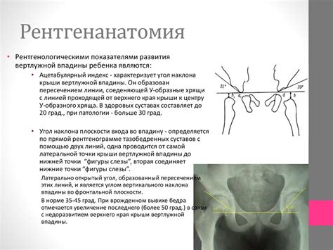 Врожденный вывих бедра дисплазия тазобедренного сустава Online Presentation