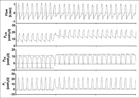 Higher Peep Decreased Negative Swing In Esophageal Pressure One Minute