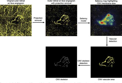 Figure 1 From Classification Of Choroidal Neovascularization Using Projection Resolved Optical