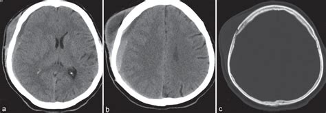 Tuberculous Subdural Empyema Mimicking Chronic Subdural Hematoma