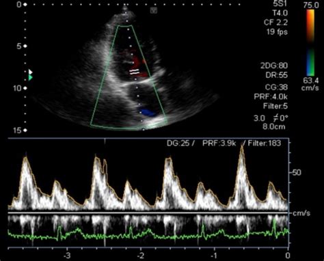 Application Of Dsp Concept For Ultrasound Doppler Image Processing