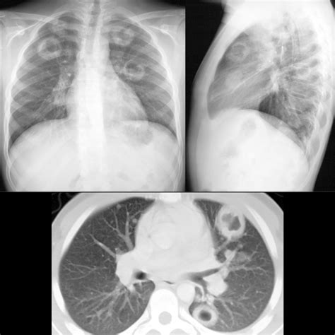 Pediatric Granulomatosis With Polyangiitis Pediatric Radiology