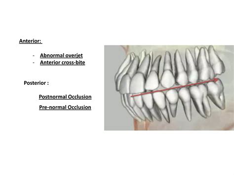 Classification Of Occlusion And Malocclusion Dr Nabil Al Zubair Ppt