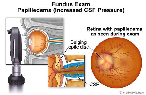 Papilledema Vs Normal Fundoscopy