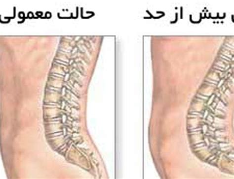 گودی و قوس کمر از درمان تا فیزیوتراپی کلینیک کمردرد مرکز درمان دیسک