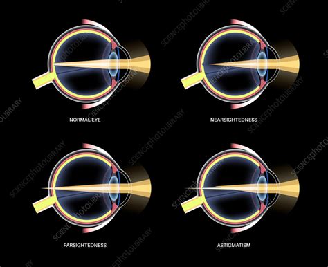 Refractive Errors That Impact Vision Illustration Stock Image F043