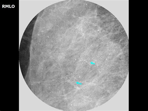 Atlas Of Breast Cancer Early Detection