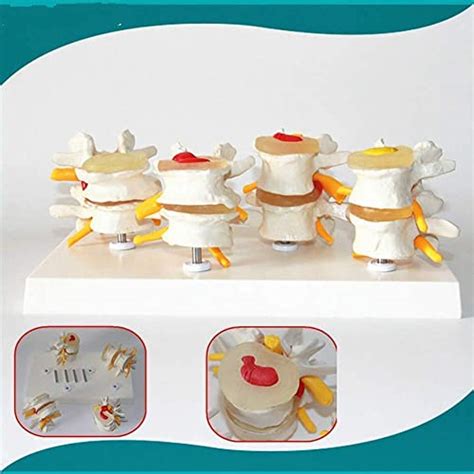 Buy Anatomy Model Assembly Assembly Model 4 Stage Human Lumbar Lesion