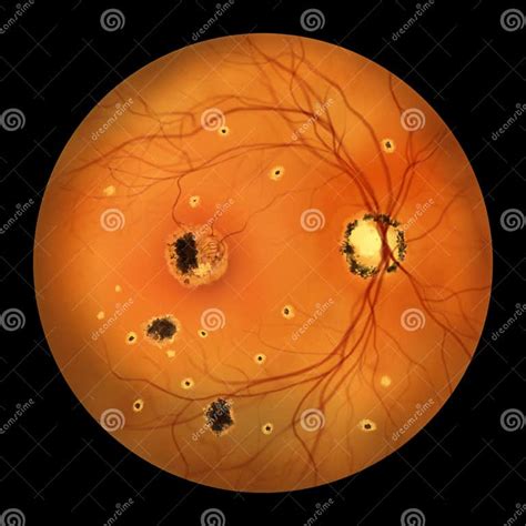 Retina In Ocular Histoplasmosis Syndrome Illustration Stock